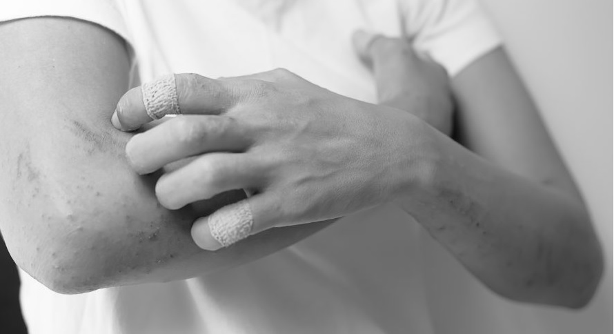 Atopický ekzém - Derma Guard